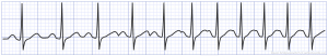 Sinus Tachycardia - Cardio Guide