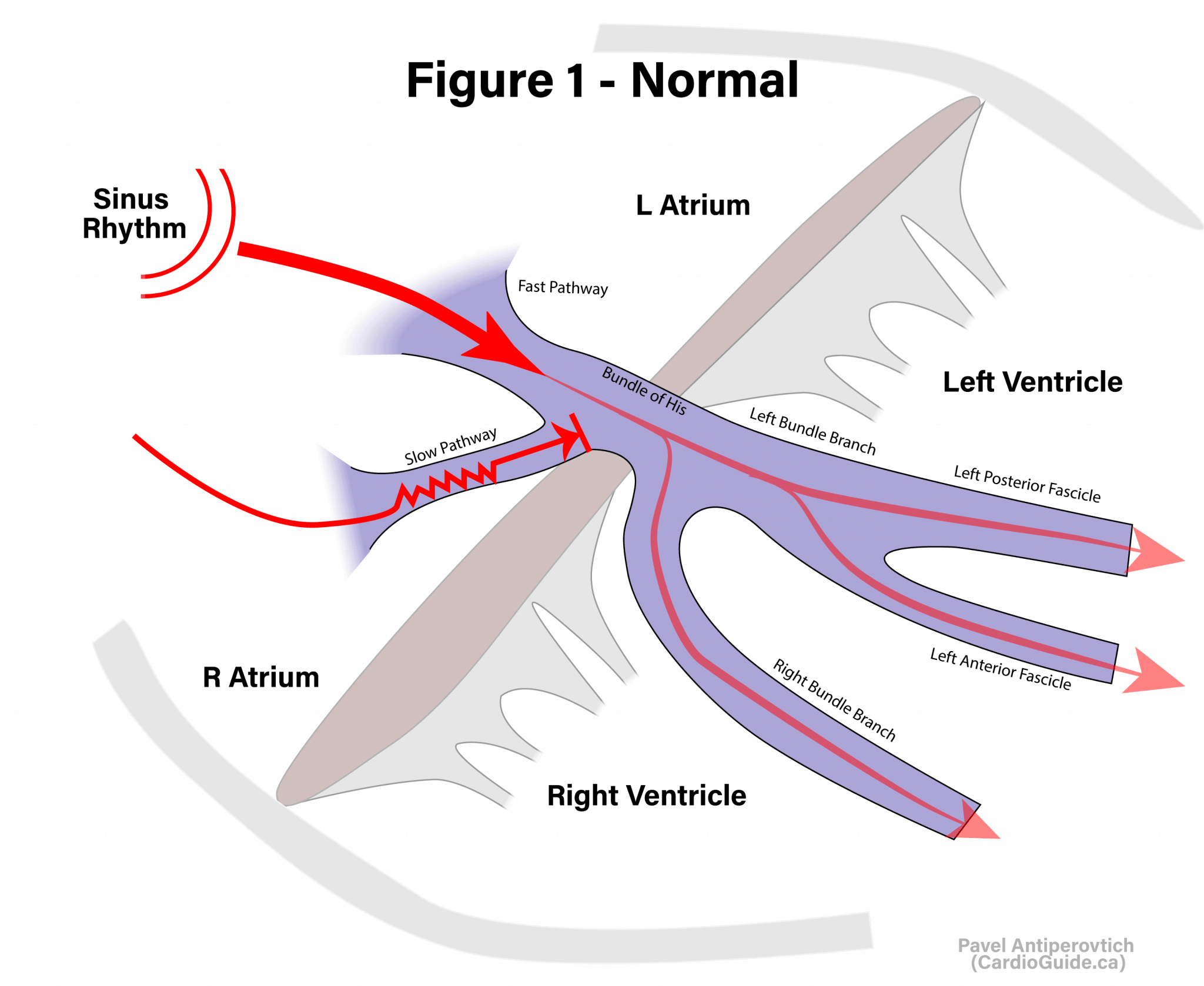 Narrow QRS Regular Tachycardia – Cardio Guide