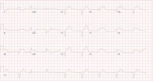 RV Infarct - Cardio Guide