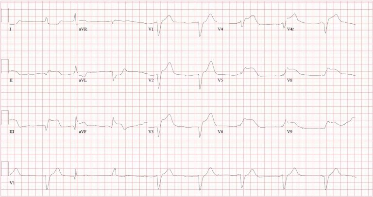RV Infarct - Cardio Guide