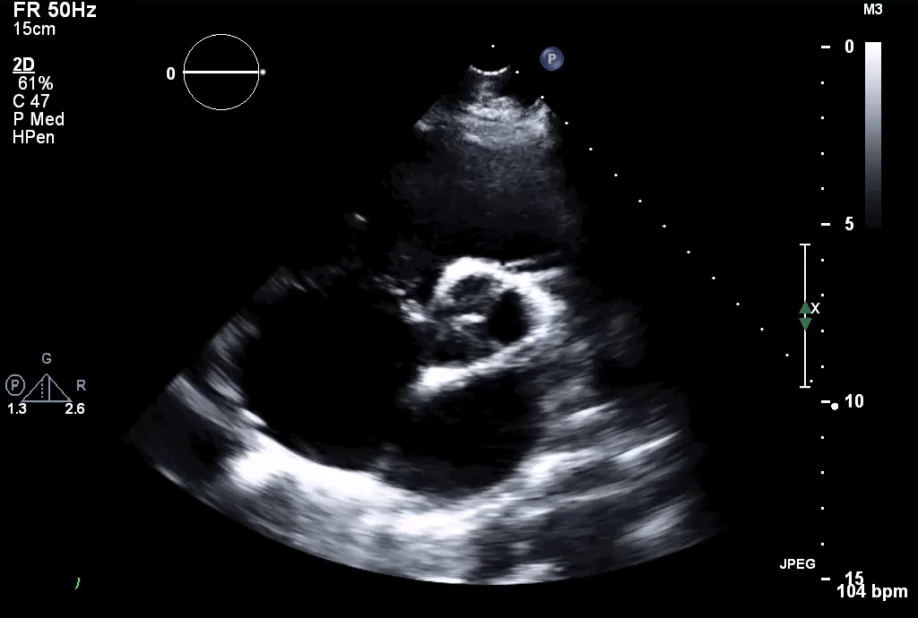 5 RVF PSAX AV - Cardio Guide