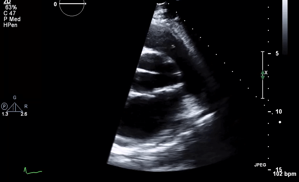 6 RVF PSAX RVOT - Cardio Guide