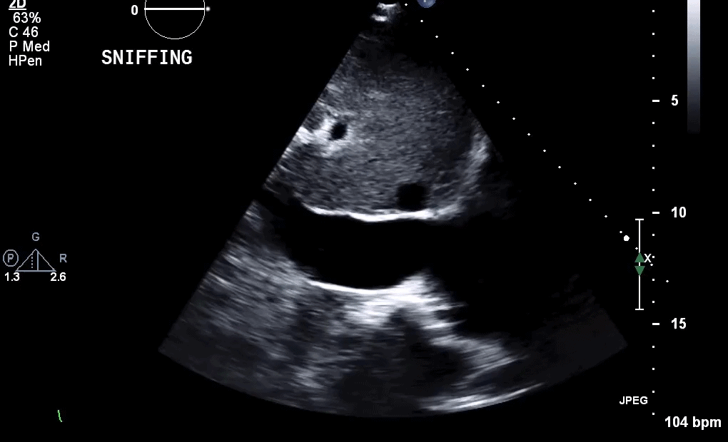 17 RVF Subcostal IVC Sniff - Cardio Guide