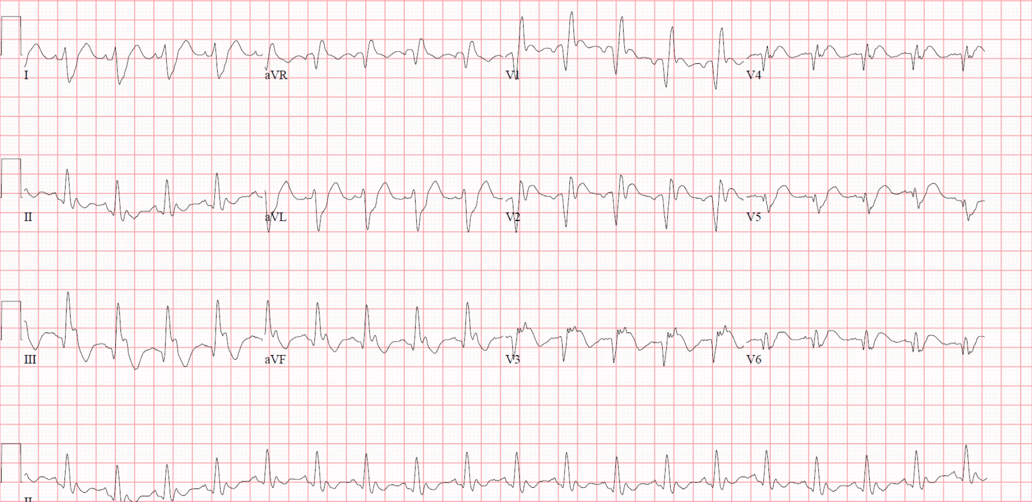 Post MI VSD - Cardio Guide