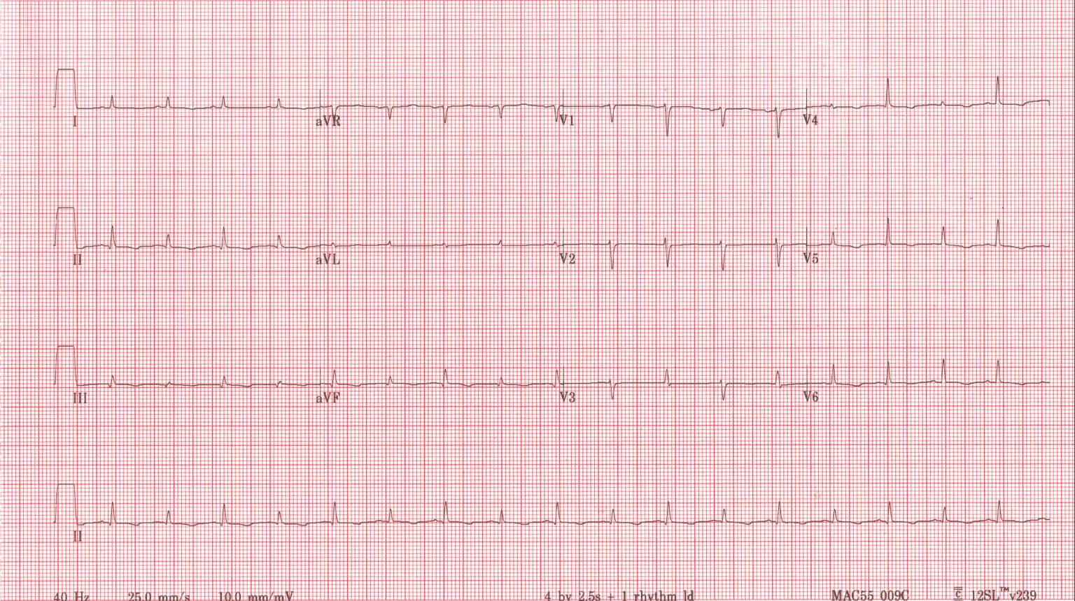 Cardiac Tamponade – Cardio Guide