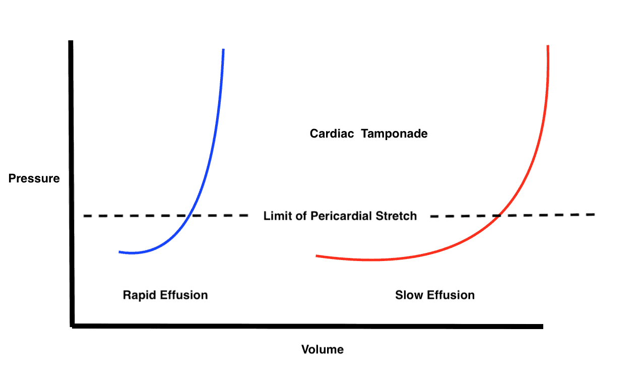 Cardiac Tamponade – Cardio Guide