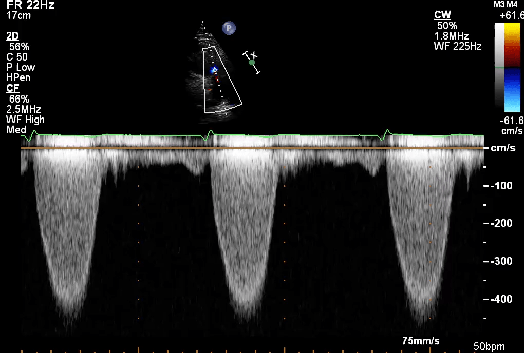 PLAX RVOT CW PS - Cardio Guide