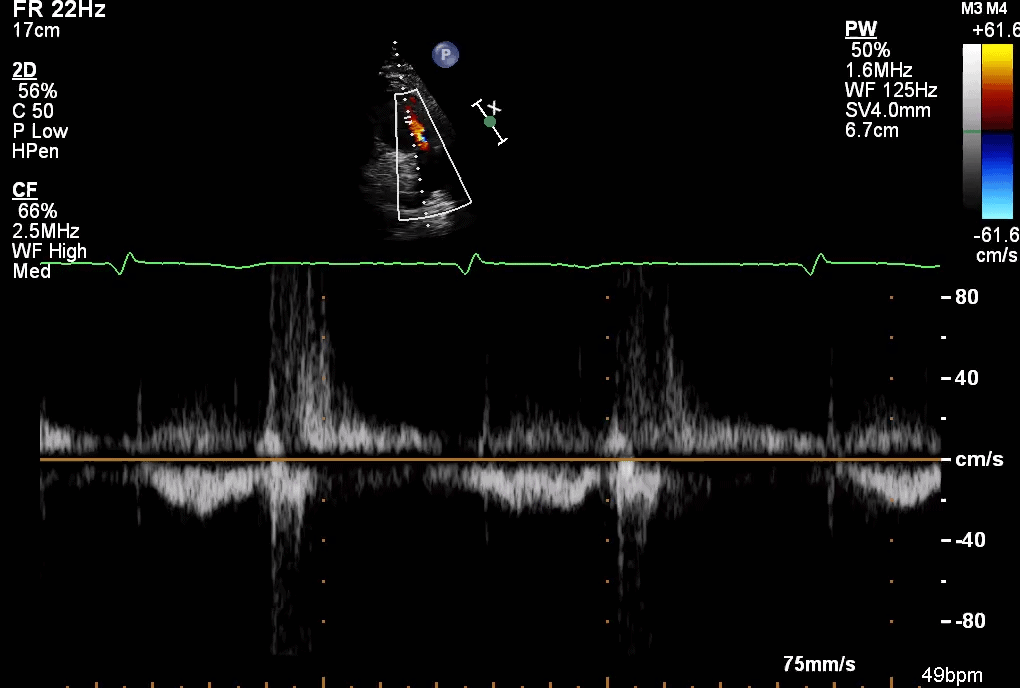 PLAX RVOT PW Sub 1 - Cardio Guide