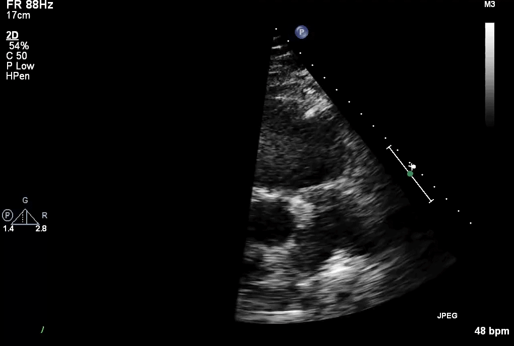 PSAX RVOT - Cardio Guide