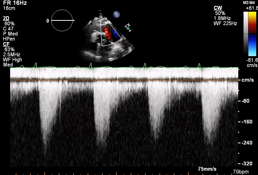 PLAX RVOT CW - Cardio Guide