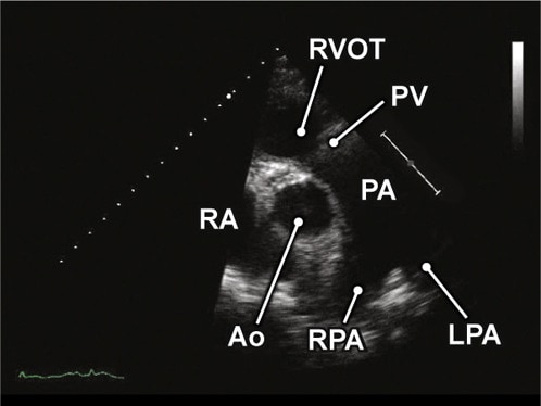 2 PSAX RVOT - Cardio Guide