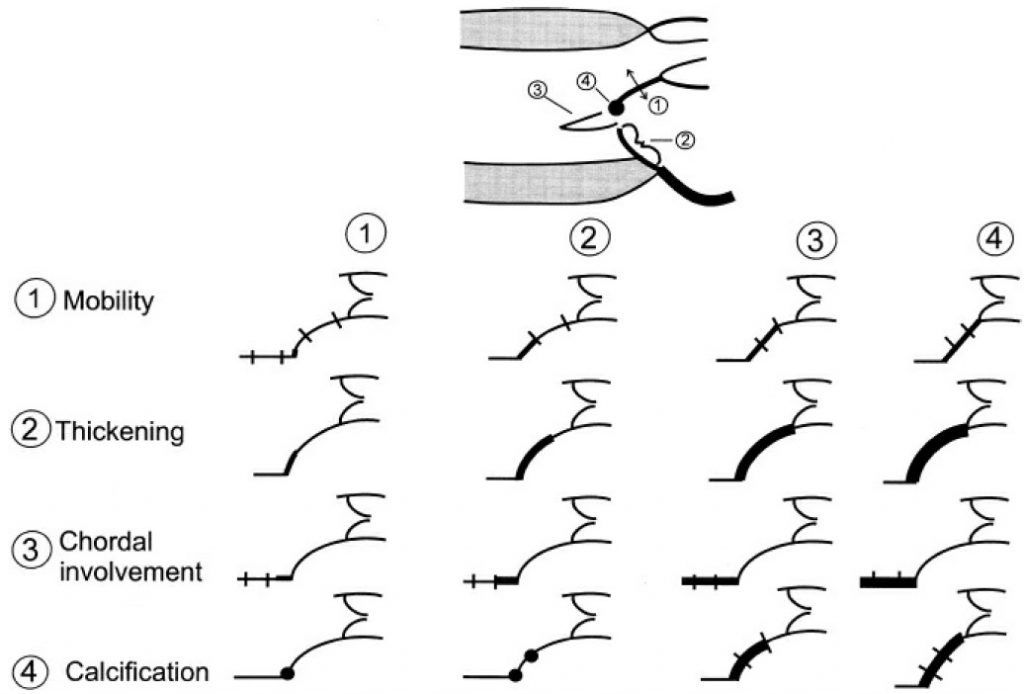 Mitral Stenosis Intervention - Cardio Guide