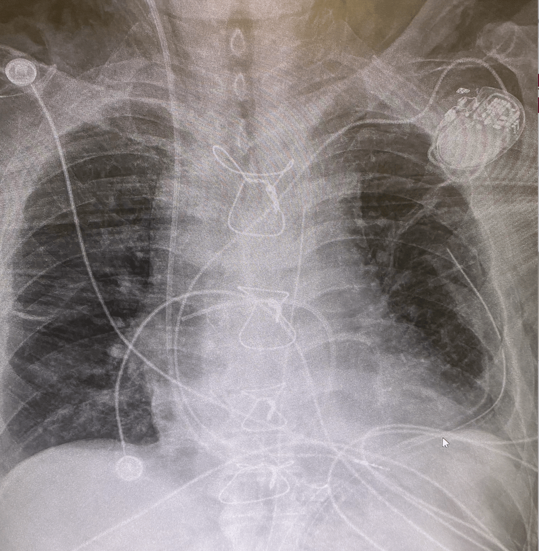 Pulmonary Artery Catheterization – Cardio Guide