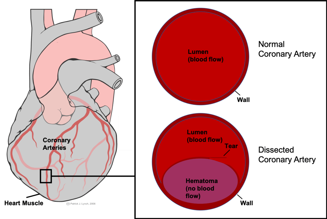 Spontaneous Coronary Artery Dissection – Cardio Guide