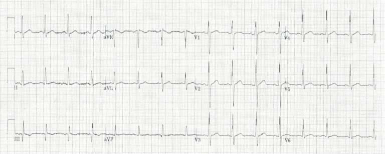 Temporary Pacing – Cardio Guide