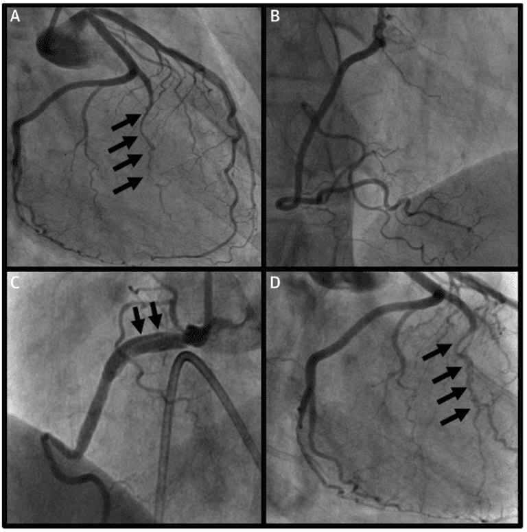 Spontaneous Coronary Artery Dissection – Cardio Guide