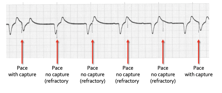 Temporary Pacing – Cardio Guide