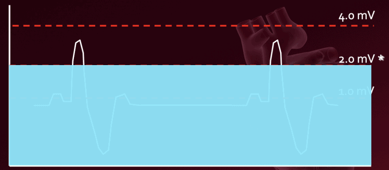 Temporary Pacing – Cardio Guide