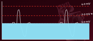 Temporary Pacing – Cardio Guide