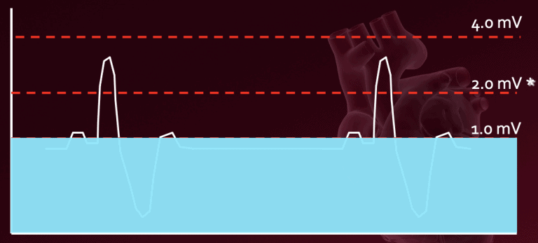 Temporary Pacing – Cardio Guide