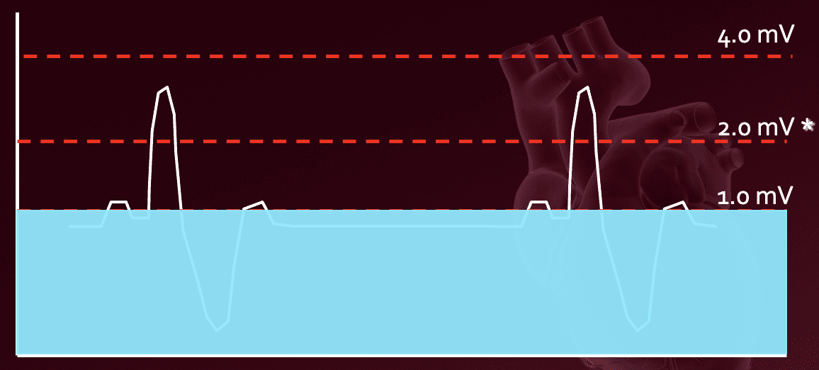 Temporary Pacing – Cardio Guide