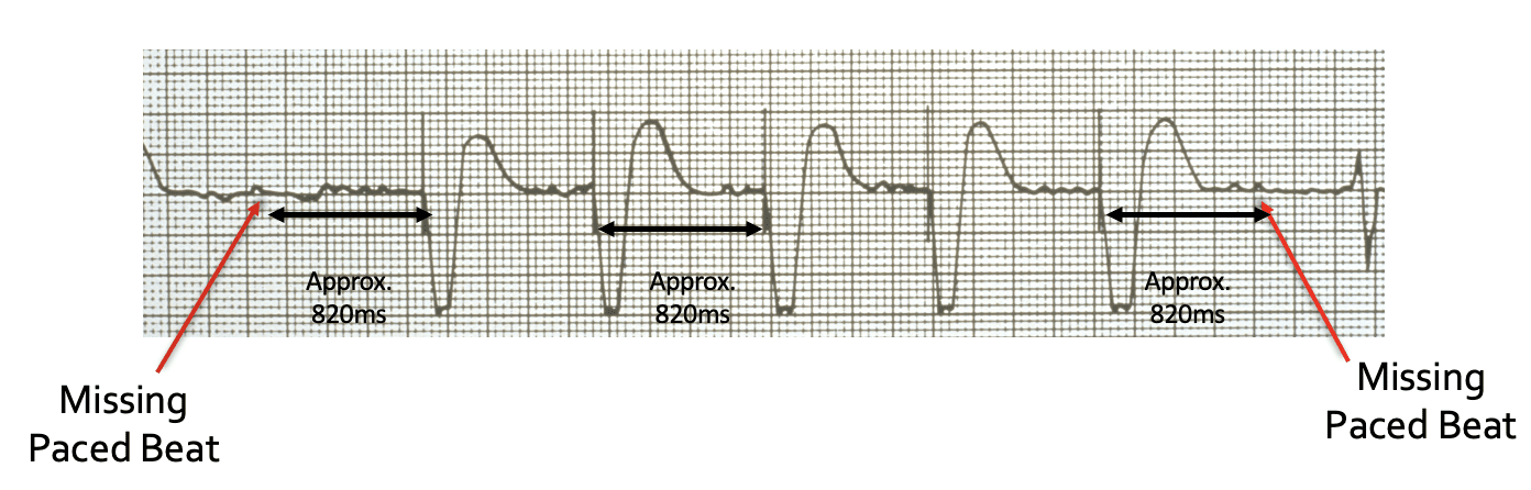 Temporary Pacing – Cardio Guide