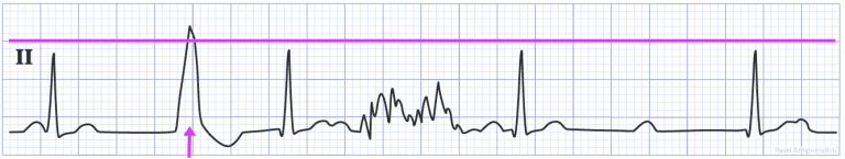 Temporary Pacing – Cardio Guide