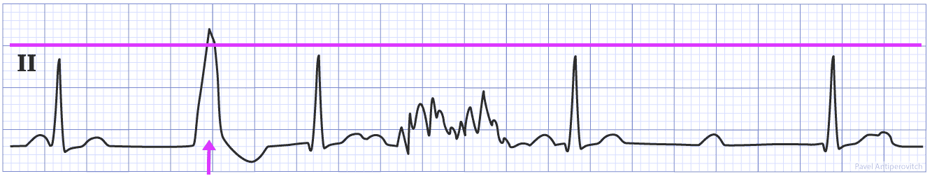 Temporary Pacing – Cardio Guide