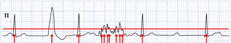 Temporary Pacing – Cardio Guide