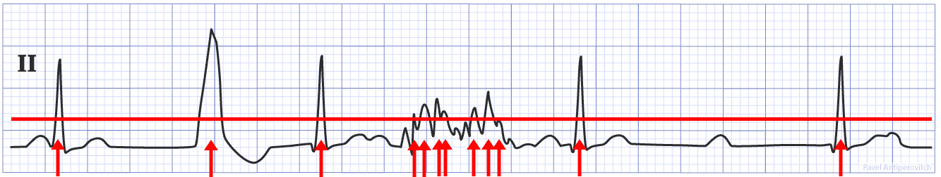 Temporary Pacing – Cardio Guide