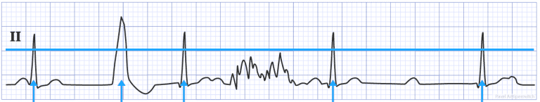 Temporary Pacing – Cardio Guide