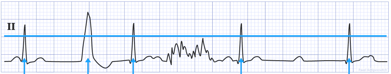Temporary Pacing – Cardio Guide