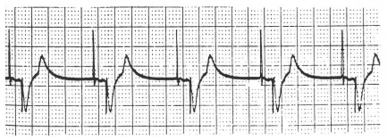 Temporary Pacing – Cardio Guide