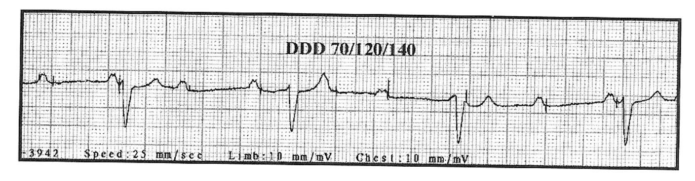 Temporary Pacing – Cardio Guide