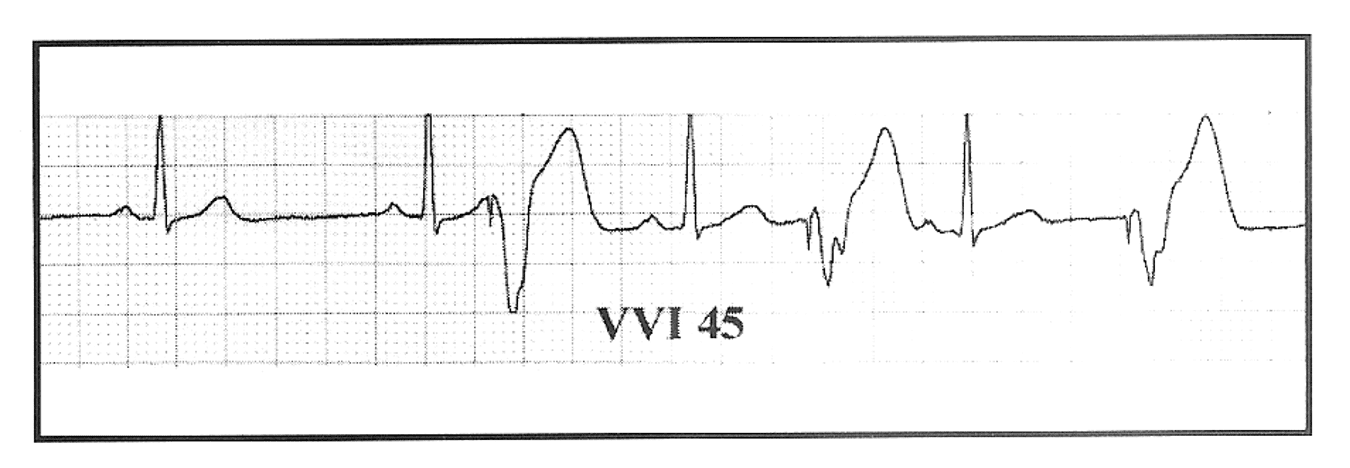 Temporary Pacing – Cardio Guide