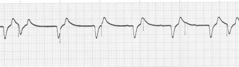 Temporary Pacing – Cardio Guide