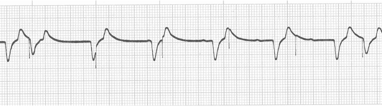 Temporary Pacing – Cardio Guide