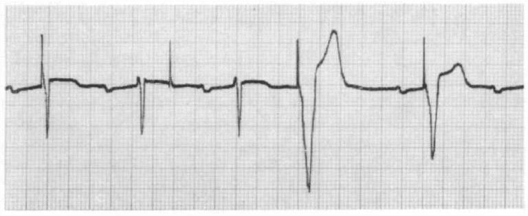 Temporary Pacing – Cardio Guide